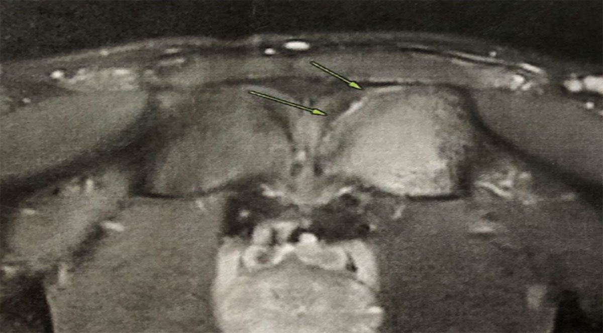 Schwere beidseitige Schambeinastentzündung - Sportärztezeitung