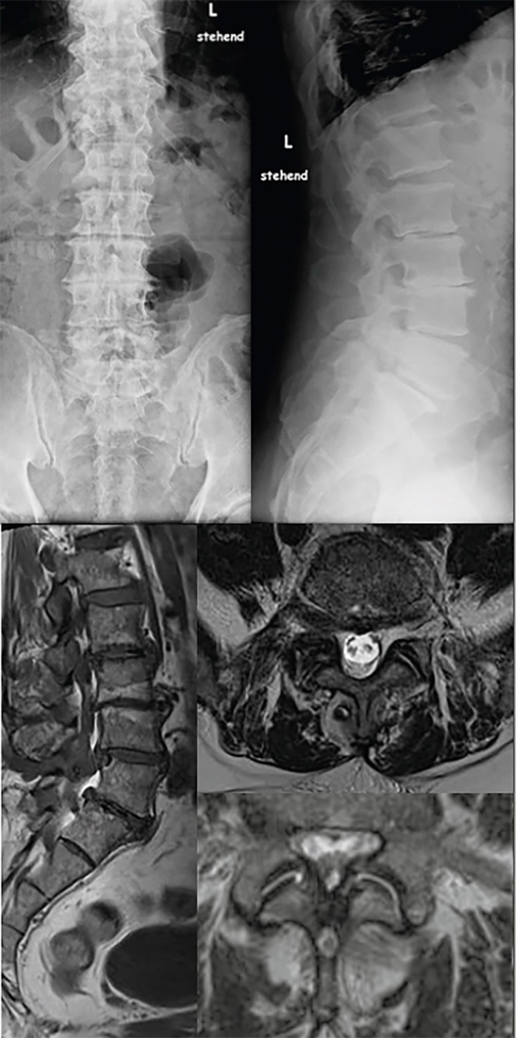 Infiltrationstherapie bei Rückenschmerzen