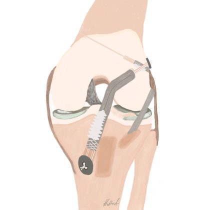 Vordere Kreuzbandruptur - Isolierte VKB Verletzung sportärztezeitung