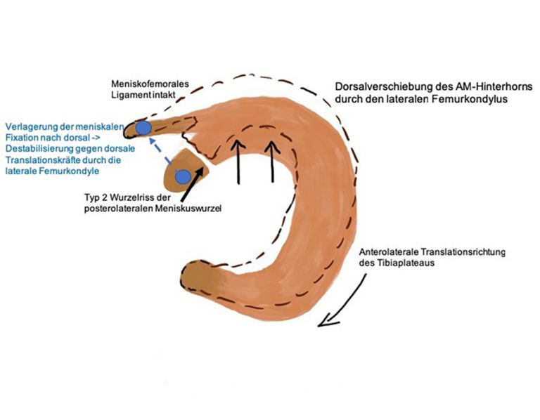 Vordere Kreuzbandruptur - Isolierte VKB Verletzung sportärztezeitung