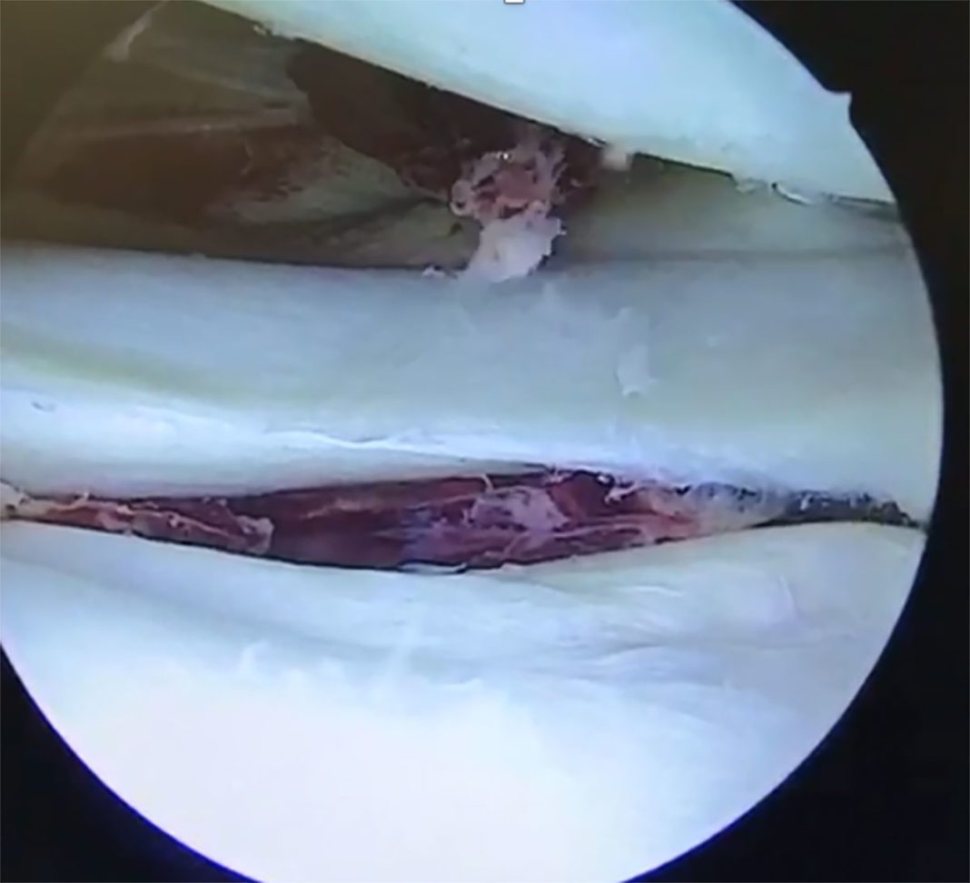 Vordere Kreuzbandruptur - Isolierte VKB Verletzung sportärztezeitung