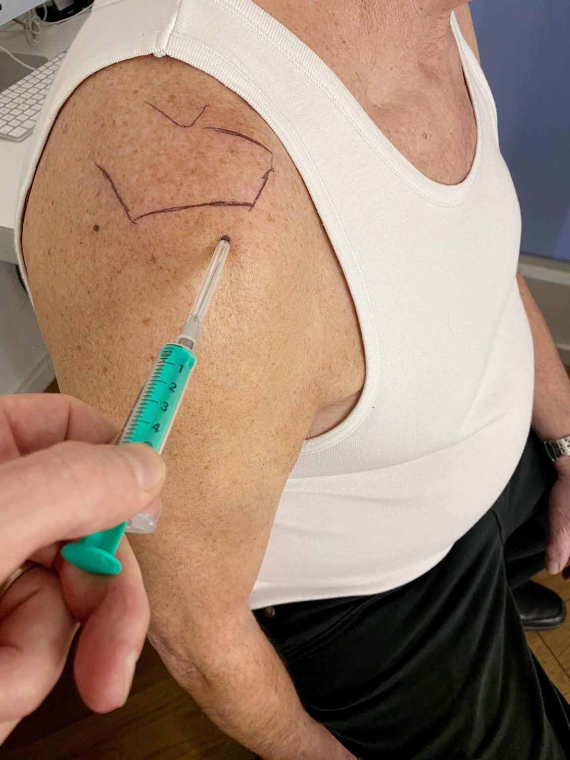 Infiltrationstechnik am Schultergelenk