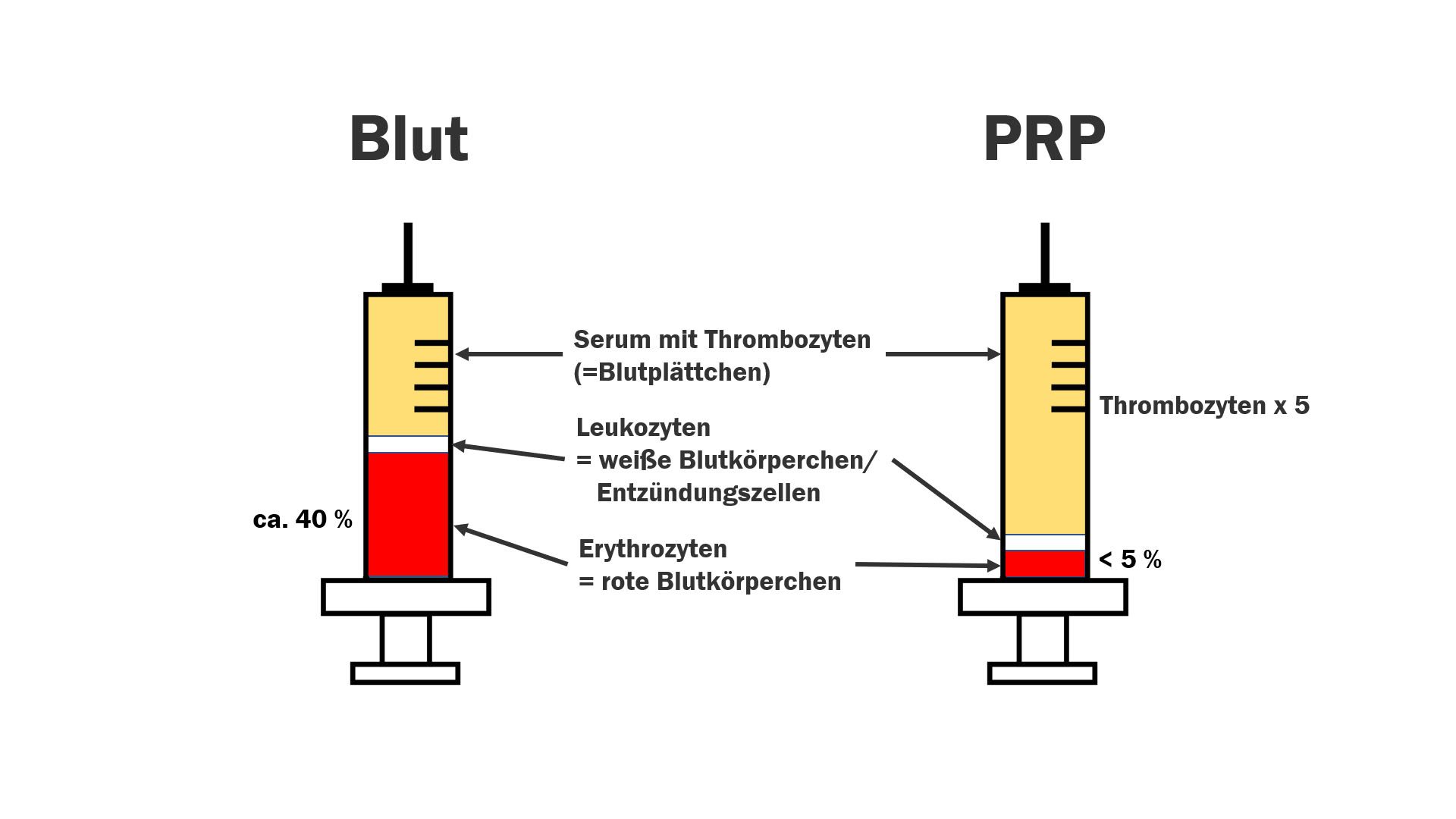 PRP und ACP - Wirksamkeit Studien sportärztezeitung