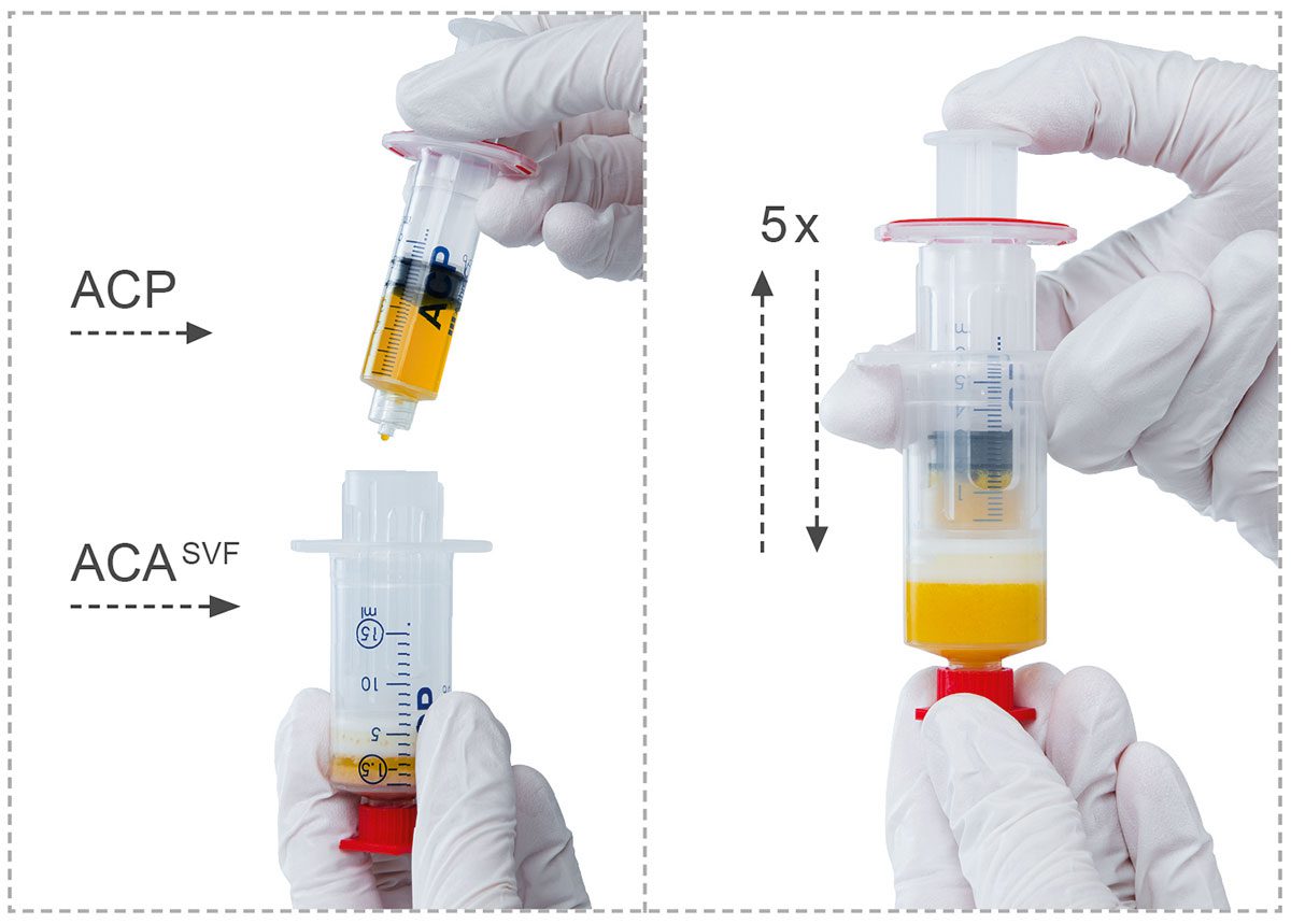 Treatment of Osteoarthritis - ACP - sportärztezeitung