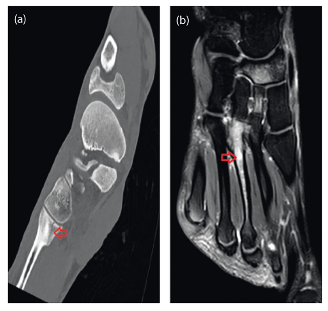 Acute and stress metatarsal fractures in sport sportärztezeitung