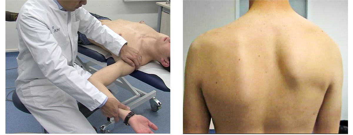 Thrower’s shoulder