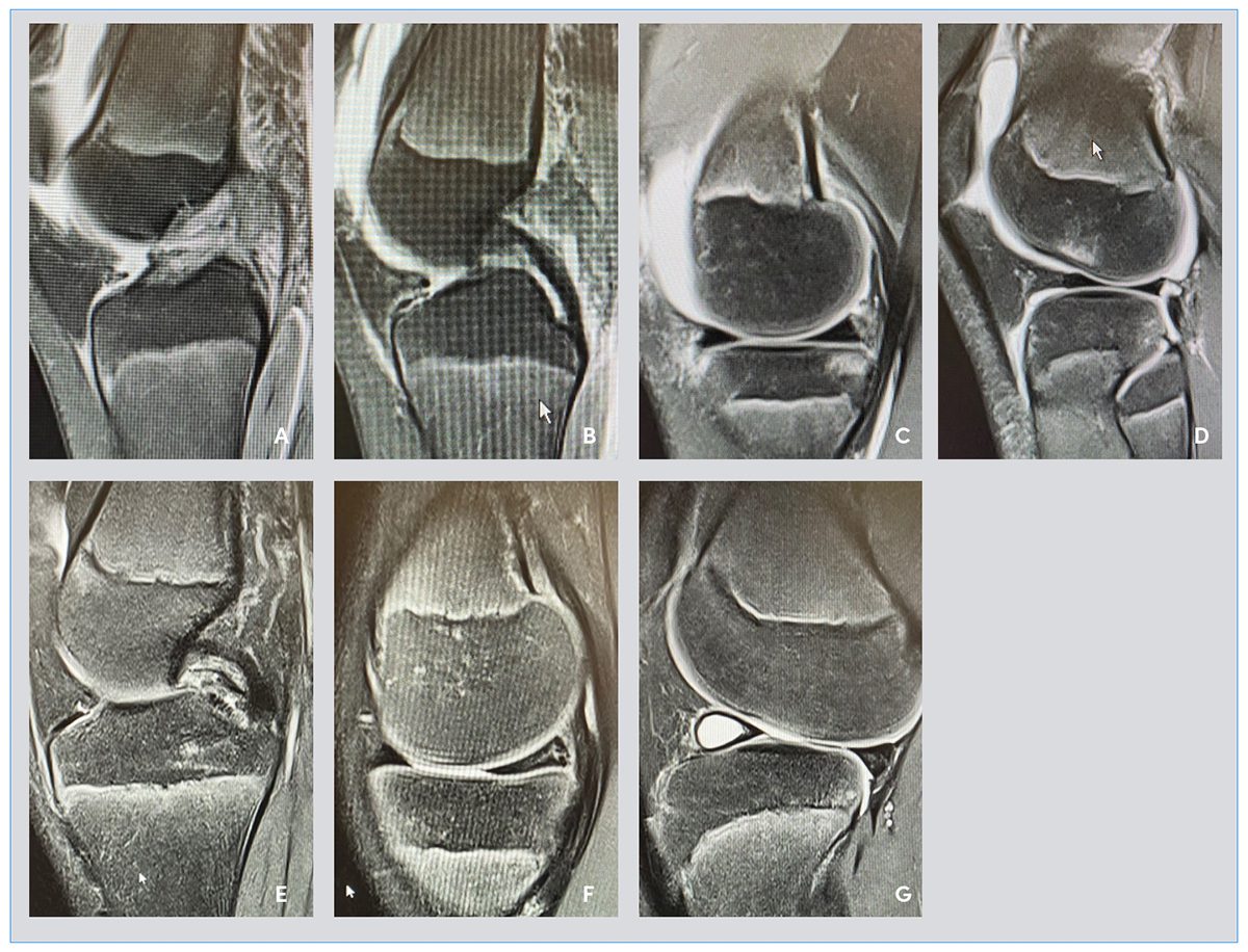 Kreuzbandriss beim Kind - Wachstumsfugen sportärztezeitung