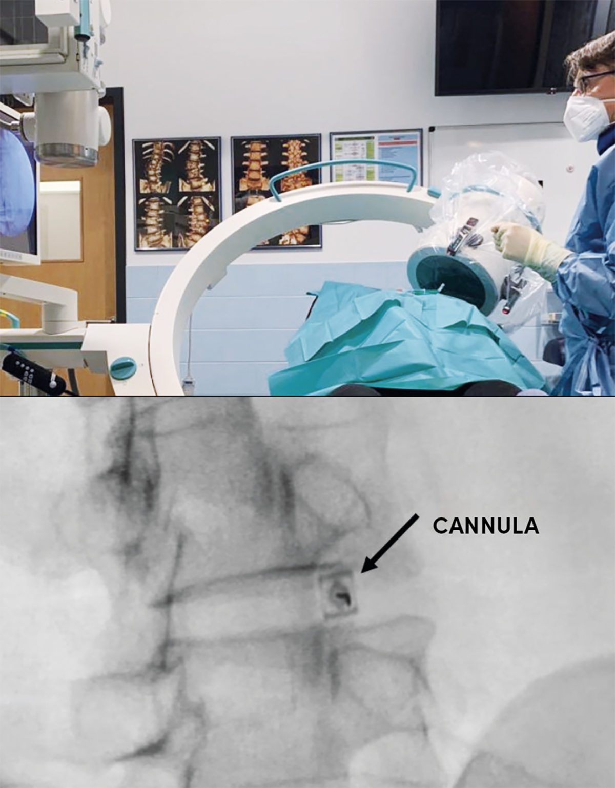 Discogenic back pain