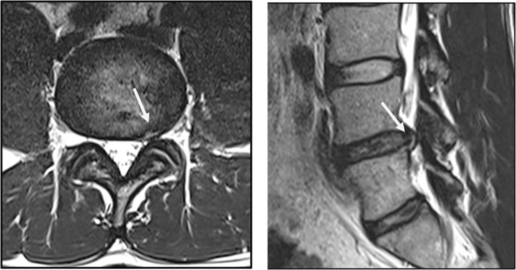 Discogenic back pain