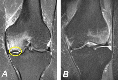 Knochenmarködeme & Strukturstörungen