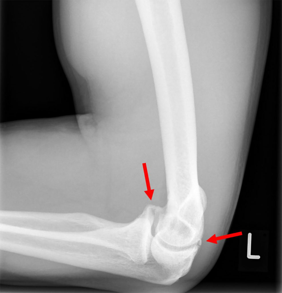Boxer’s Elbow