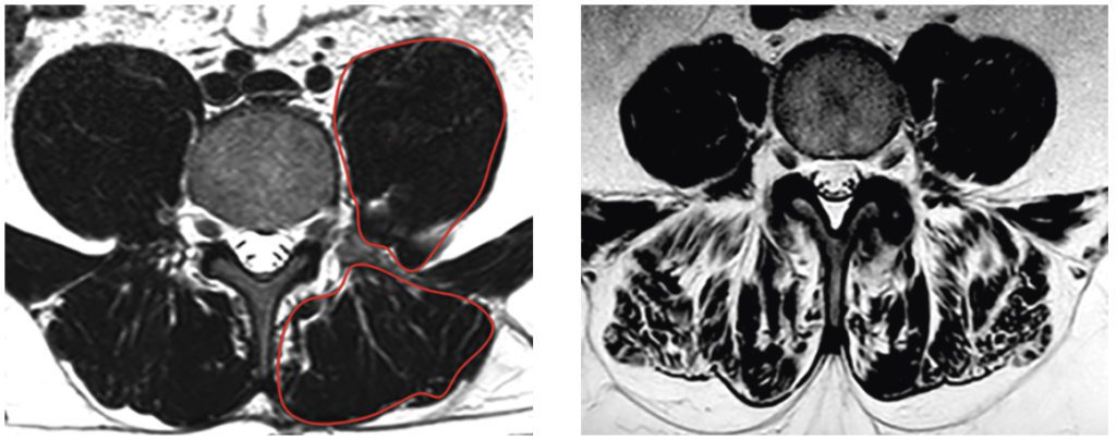 Die tiefliegende autochthone Rückenmuskulatur