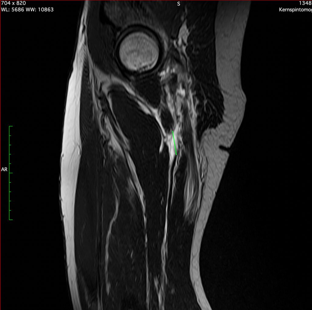 Muskelabriss im Leistungssport