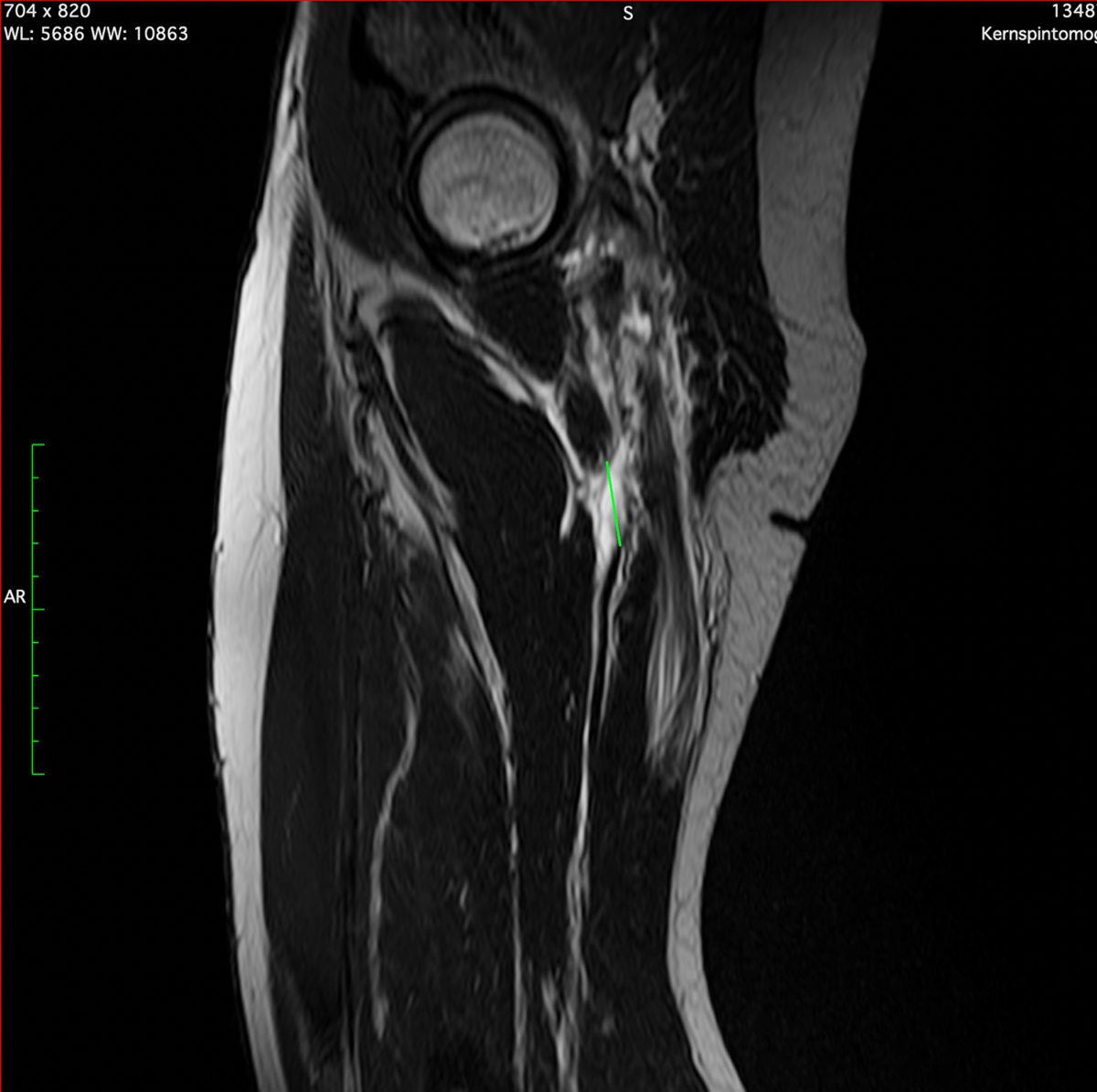Muskelabriss im Leistungssport