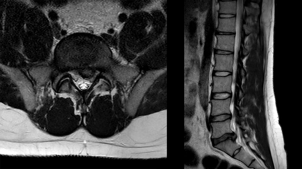 Lumbaler Rückenschmerz