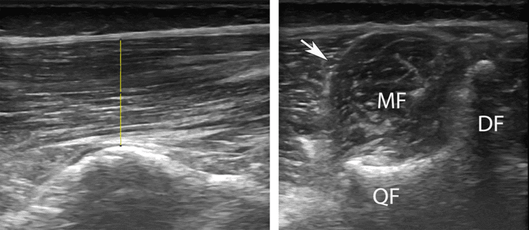 Autochthone Rückenmuskulatur
