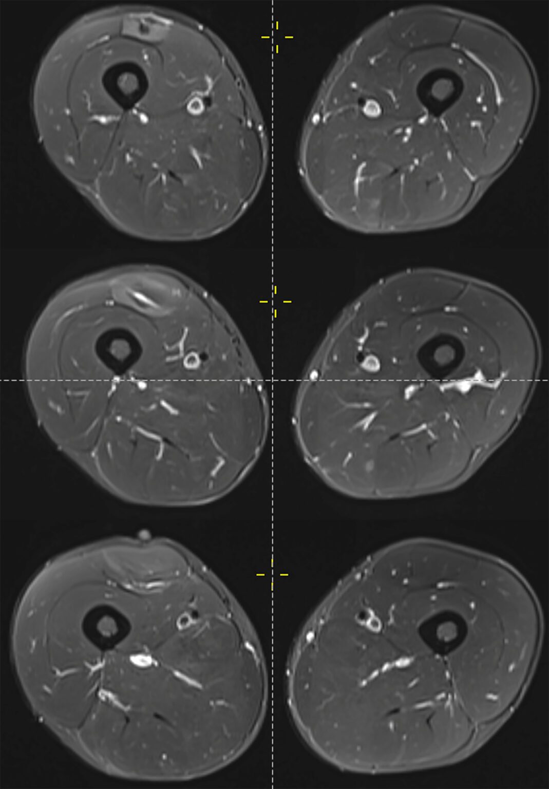 Oberschenkelverletzung