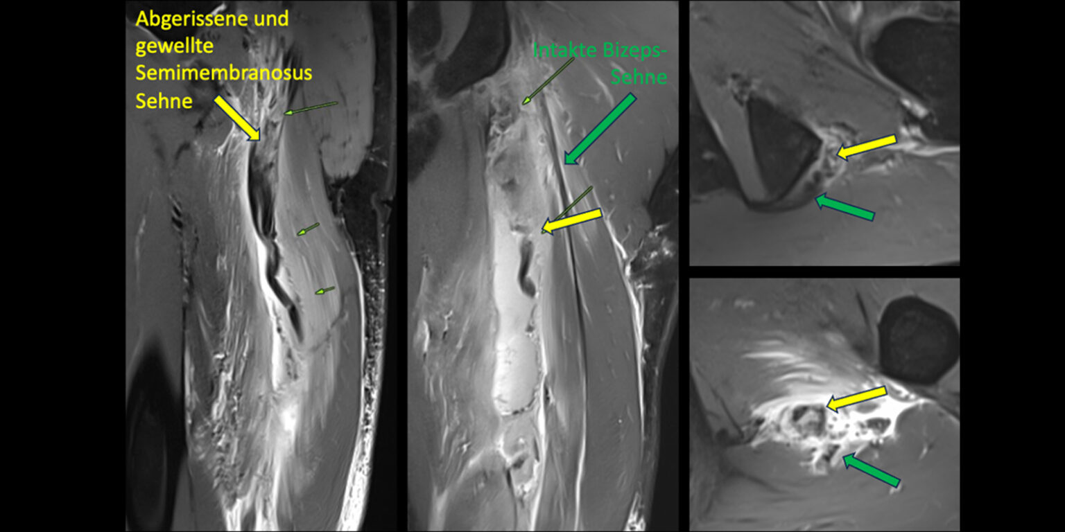 Beckennahe Hamstring­verletzungen