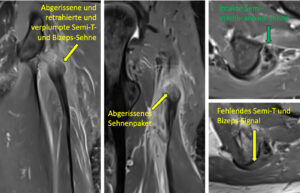 Beckennahe Hamstring­verletzungen
