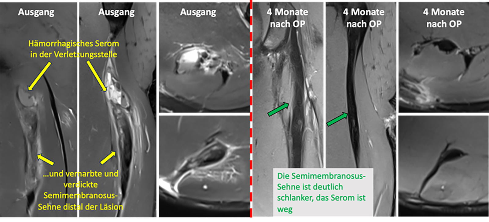 Beckennahe Hamstring­verletzungen