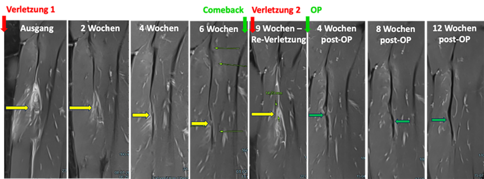 Beckennahe Hamstring­verletzungen