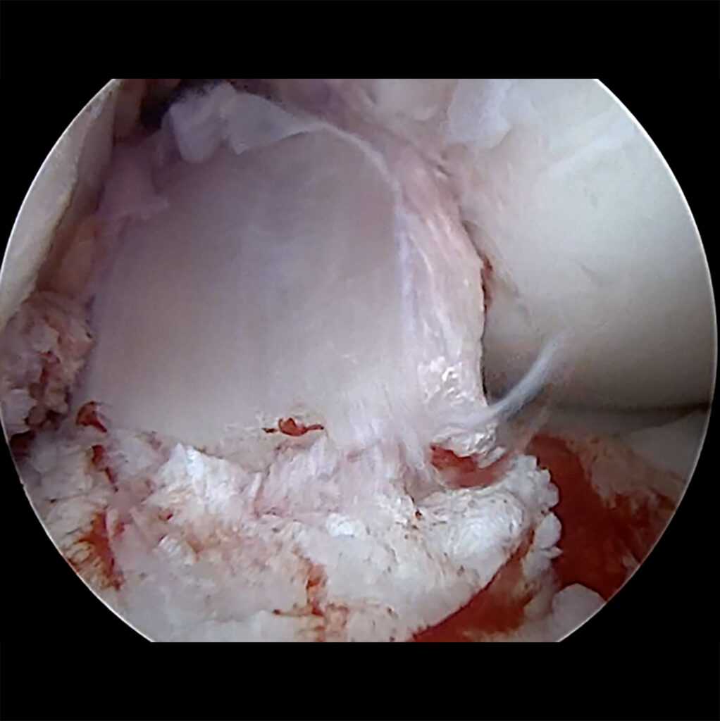 Multimodale Therapie der vorderen Kreuzbandruptur